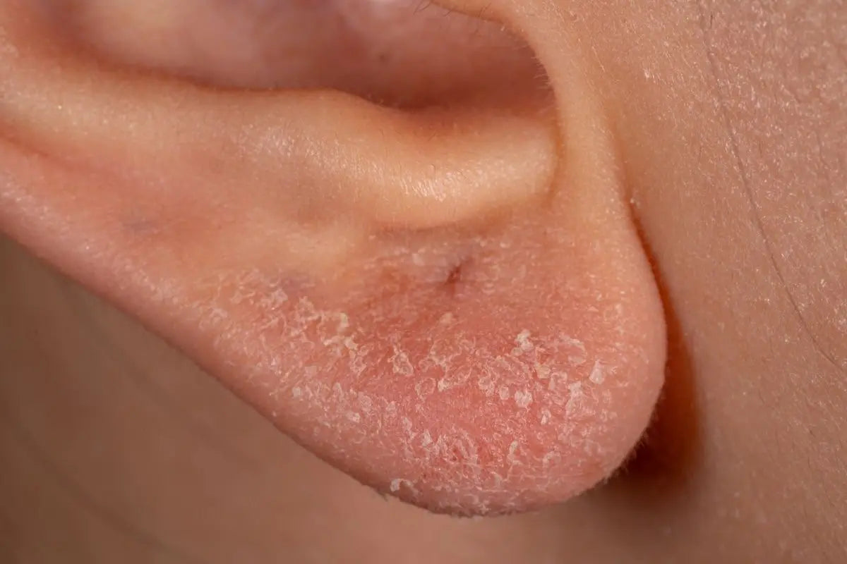 Allergia al nichel: sintomi, diagnosi e trattamento – Farmae - Para ...